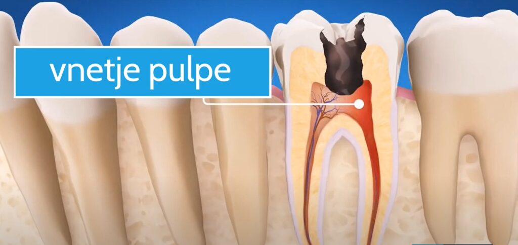 Zdravljenje zoba, puljenje zoba